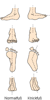 Fuß- und Rückenprobleme - Skoliose-Info-Forum